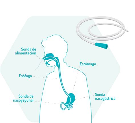 Descubre Todo Sobre la Sonda Nasogástrica: Tipos, Cómo Colocarla y Sus ...